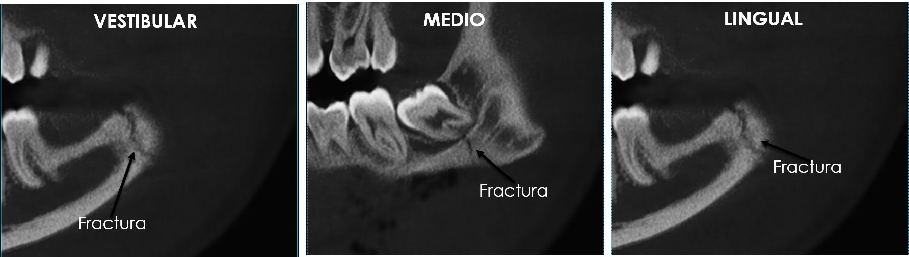 La fractura mandibular