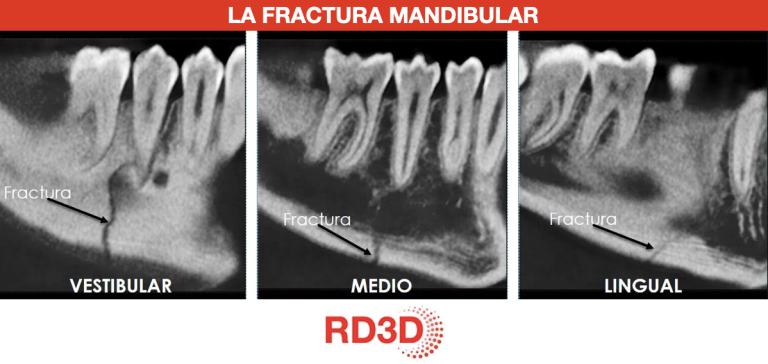 La fractura mandibular