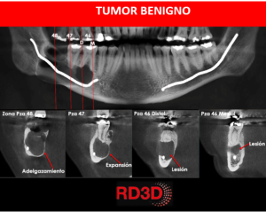 Tumores Malignos y Benignos en el Hueso Maxilar y Mandibular evaluados ...