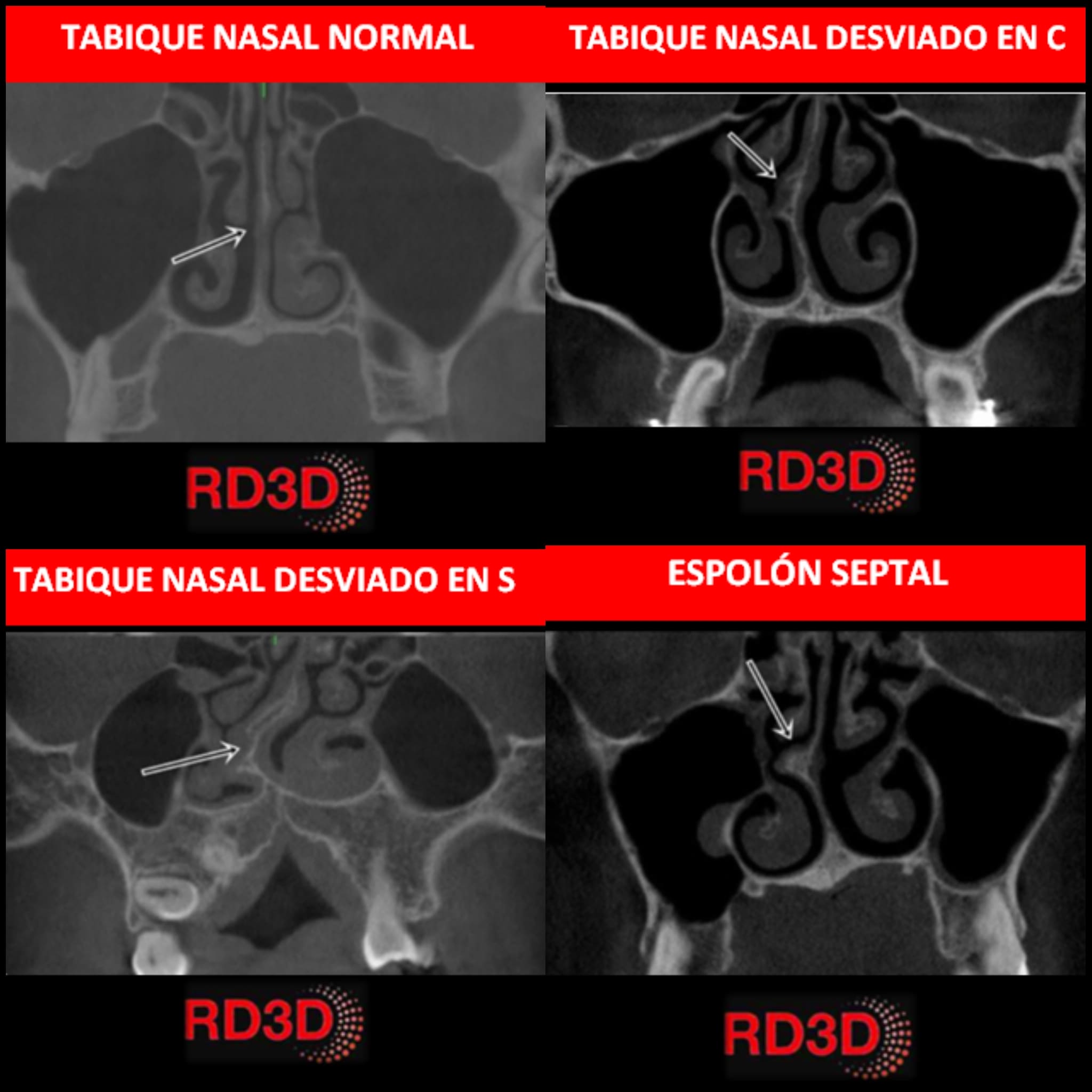 Evaluación del tabique nasal desviado con CBCT